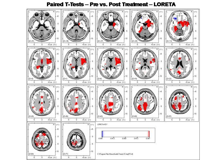 NeuroStat – NeXus | NSET Mind Media